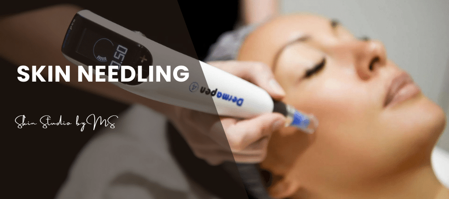 Skin Needling – SkinStudiobyMS